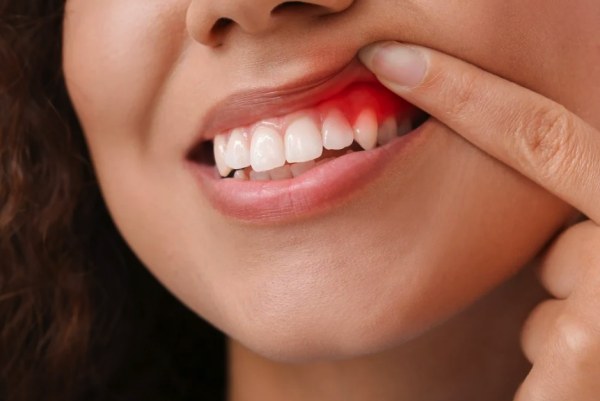 Gingivitis And Treatment Options How It Is Cured Lovesmilegr